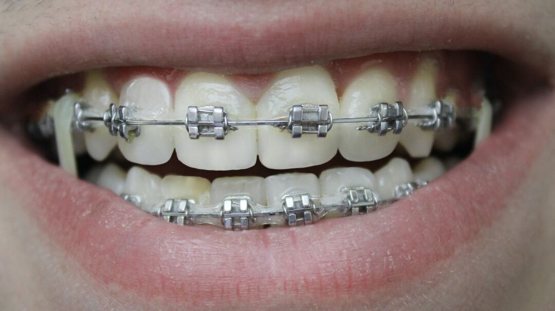 ¿Qué Significa Soñar Con Brackets?
